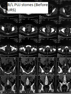 Ureterorenoscopy (URS)
