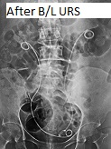 Ureterorenoscopy (URS)