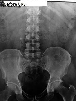 Ureterorenoscopy (URS)