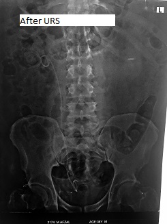 Ureterorenoscopy (URS)