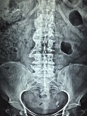 Ureterorenoscopy (URS)