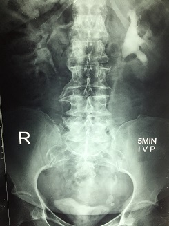 Ureterorenoscopy (URS)