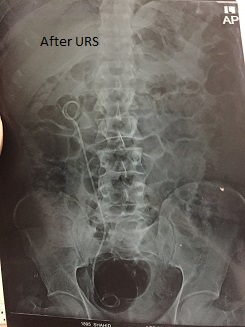 Ureterorenoscopy (URS)