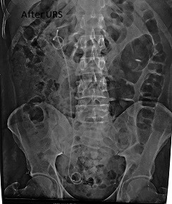 Ureterorenoscopy (URS)