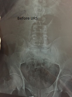 Ureterorenoscopy (URS)